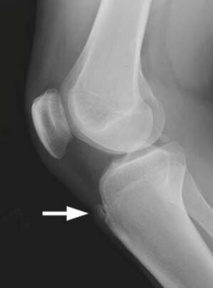 Tendinopathie Patellaire: Solutions Pratiques | OsteoMag